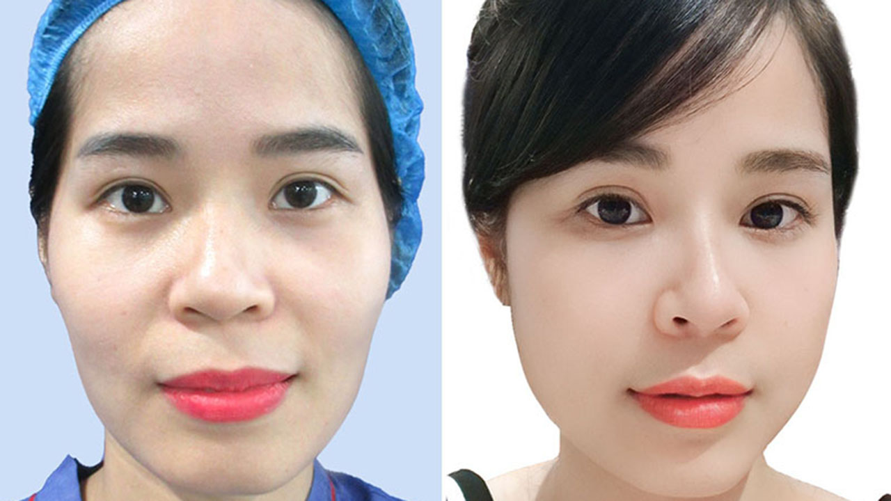 Fat Grafting for Facial Volume Restoration – The Secret to Rejuvenation ...