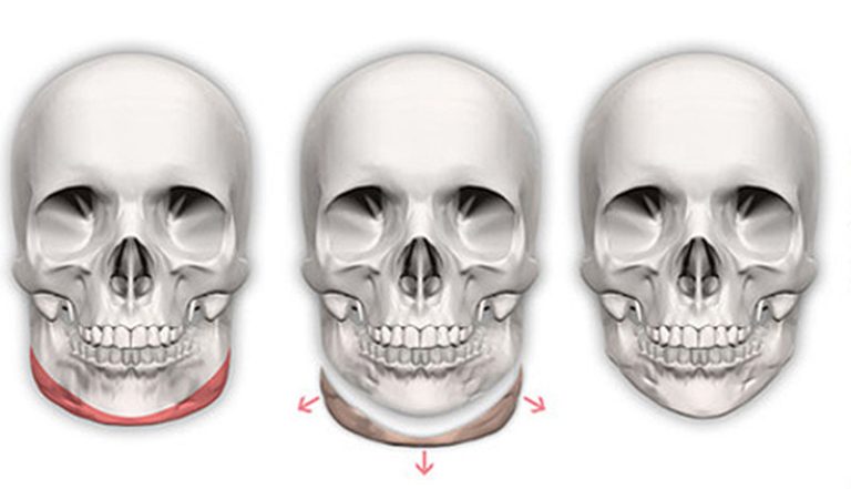 A-Z Guide on Jaw Contouring with Kangnam Aesthetic Hospital