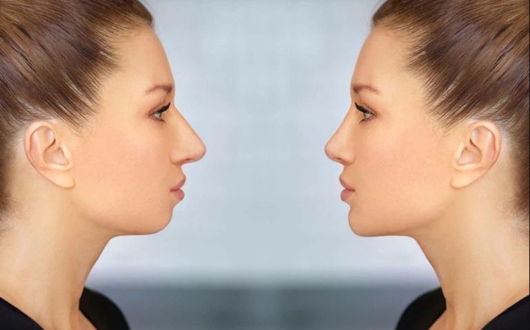 Sliding Genioplasty in Vietnam: Chin Reshaping Surgery for a More ...