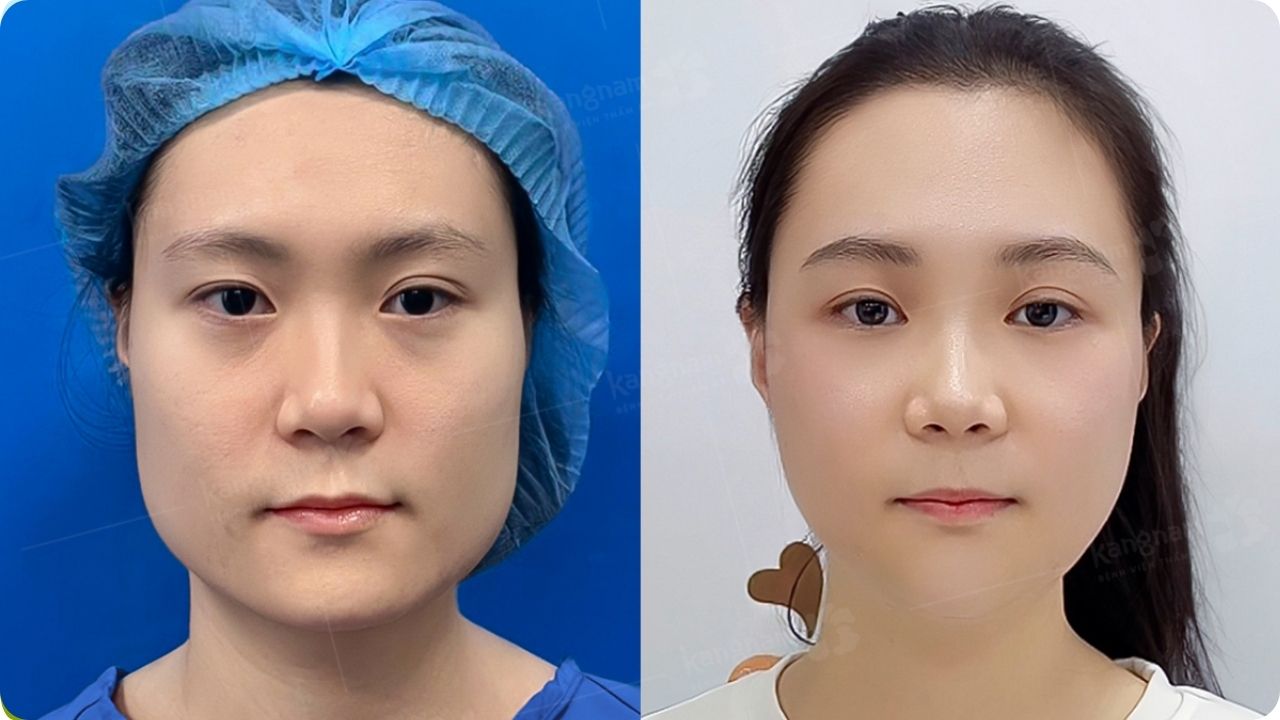 How to Maintain Cosmetic Surgery Results: A Timeline-Based Guide for ...