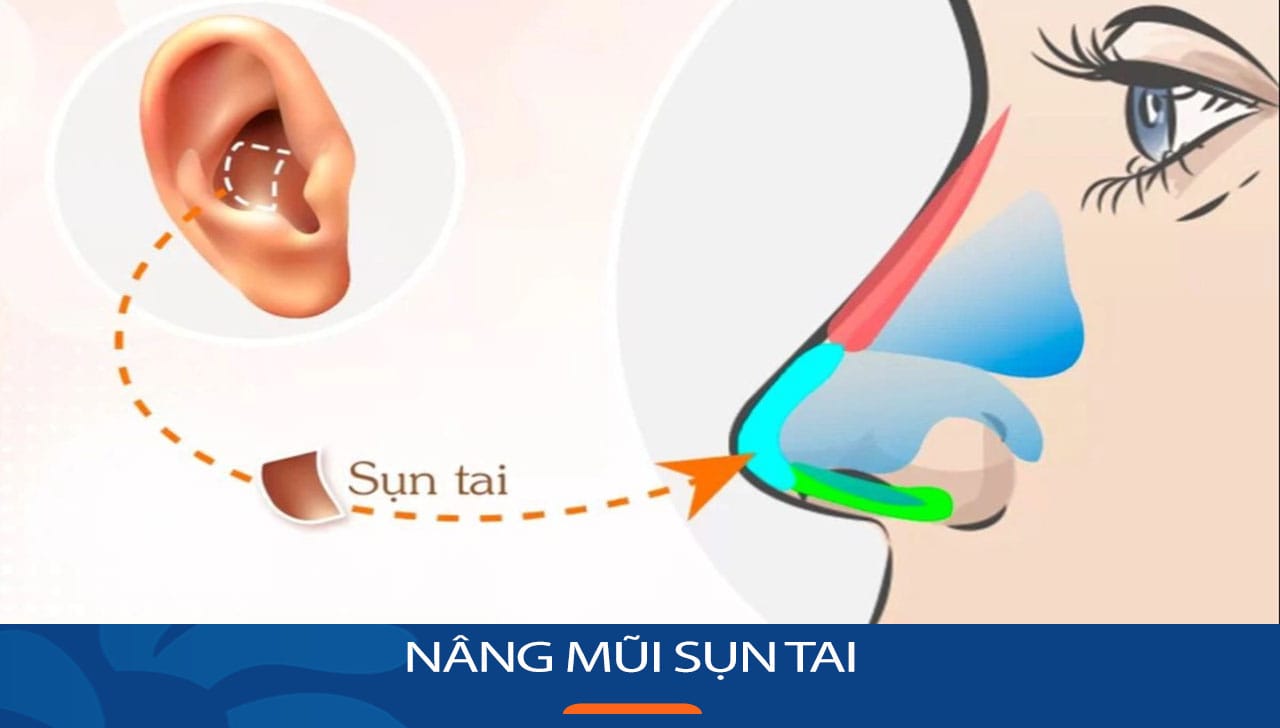 Địa Chỉ Nâng Mũi Sụn Tai Cho Kh Việt Kiều Về Nước